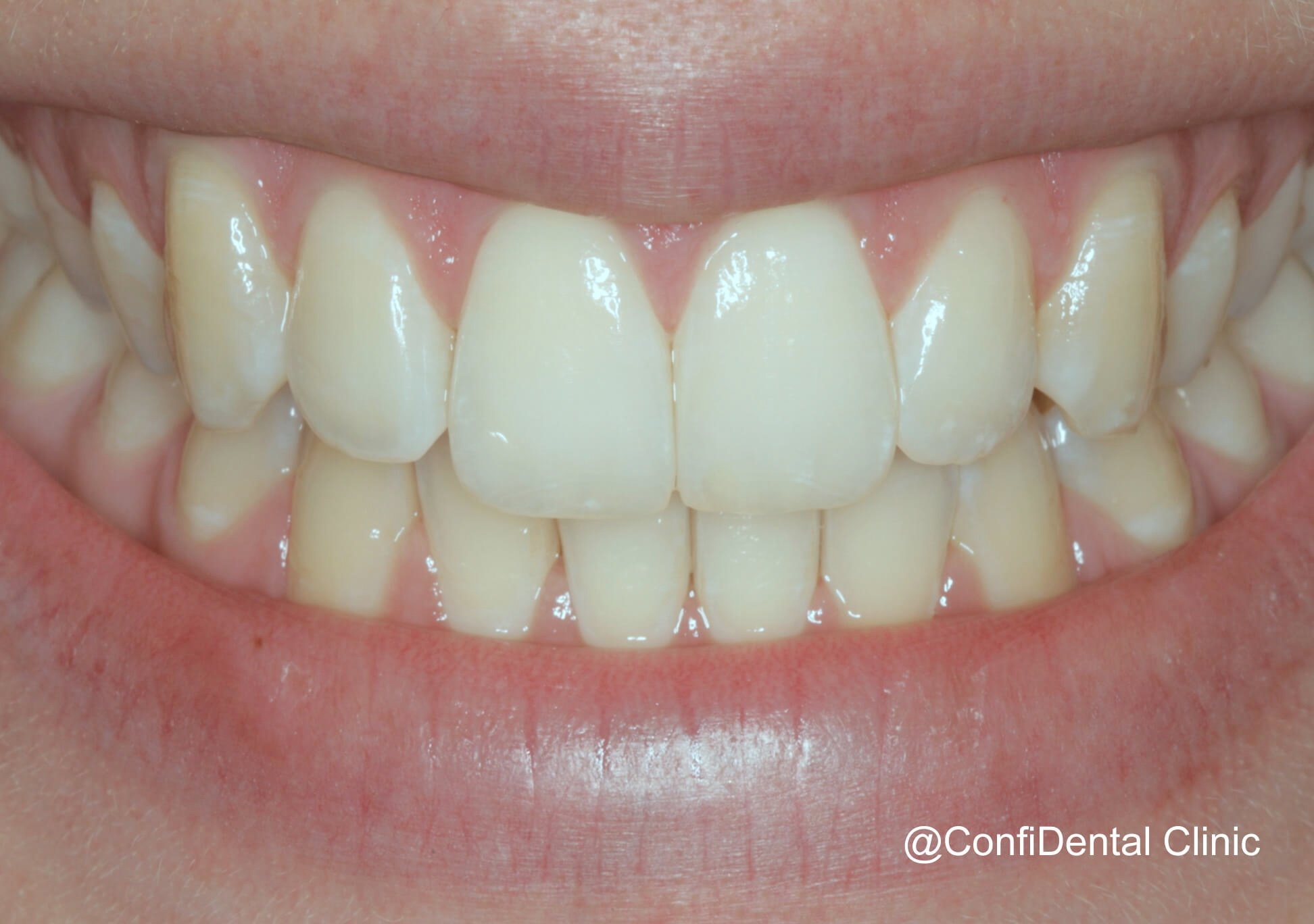 Teeth Straightening in Morden | Invisalign & Braces | ConfiDental ...